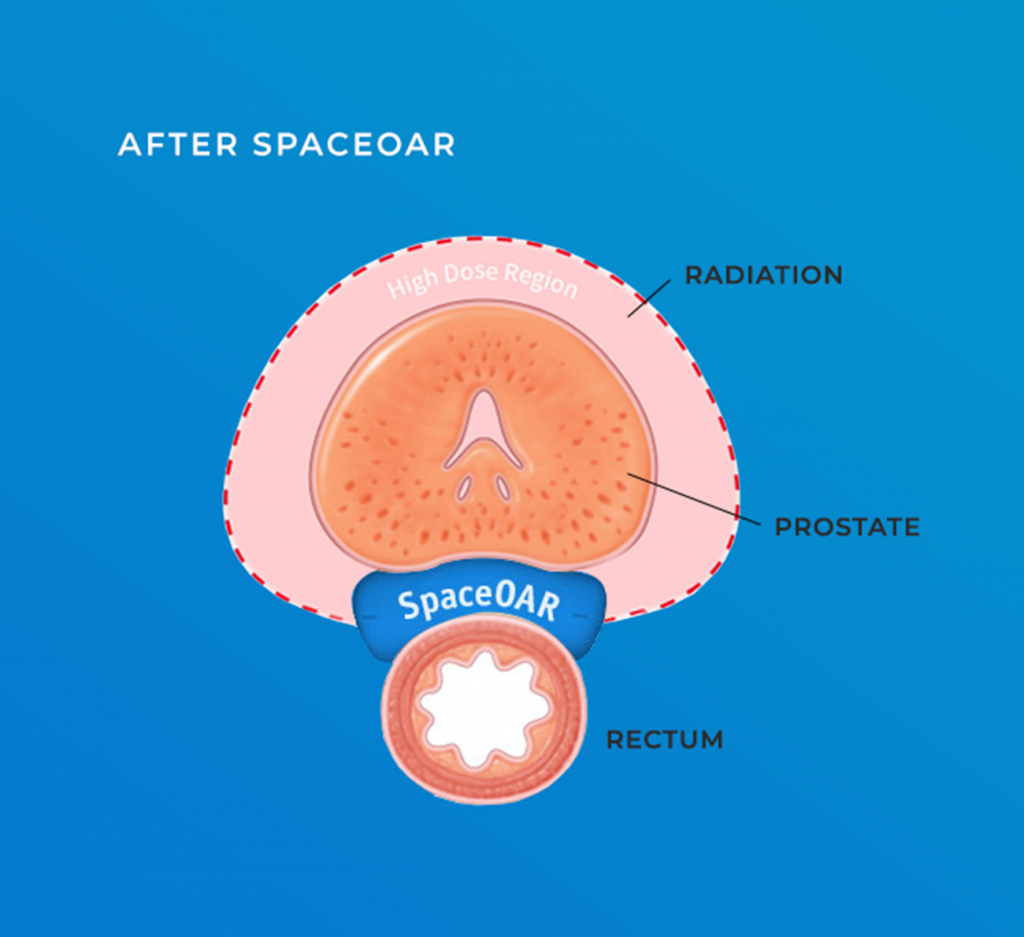 SpaceOAR Hydrogel For Prostate Treatment - California Protons